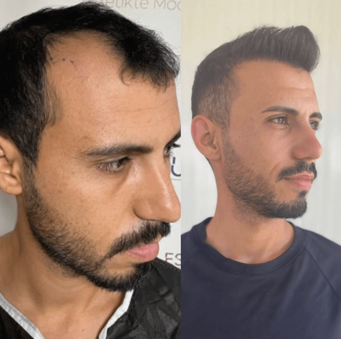 Hair Transplant in Turkey - Plastic Surgery Supervised Hair Transplant ...