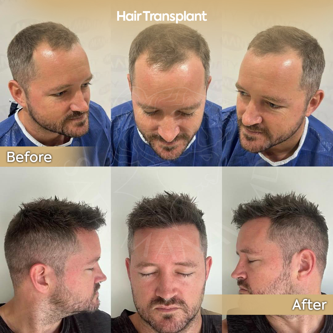 Hair Transplant in Turkey - Plastic Surgery Supervised Hair Transplant ...