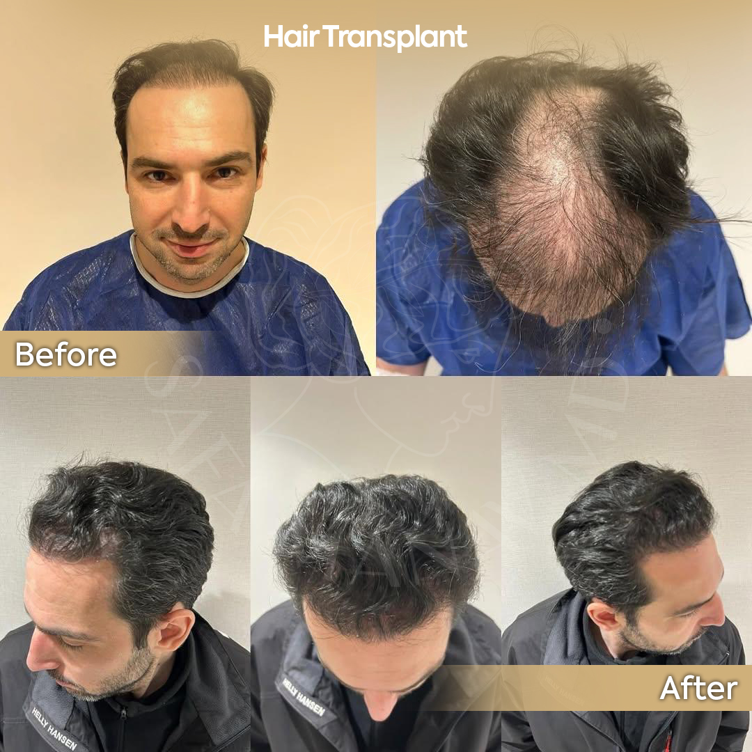 Hair Transplant in Turkey - Plastic Surgery Supervised Hair Transplant ...