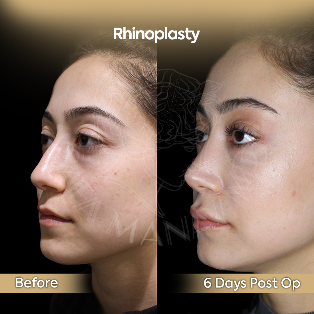 2025 Medical Tourism European Board Certified Rhinoplasty / Nosejob in ...