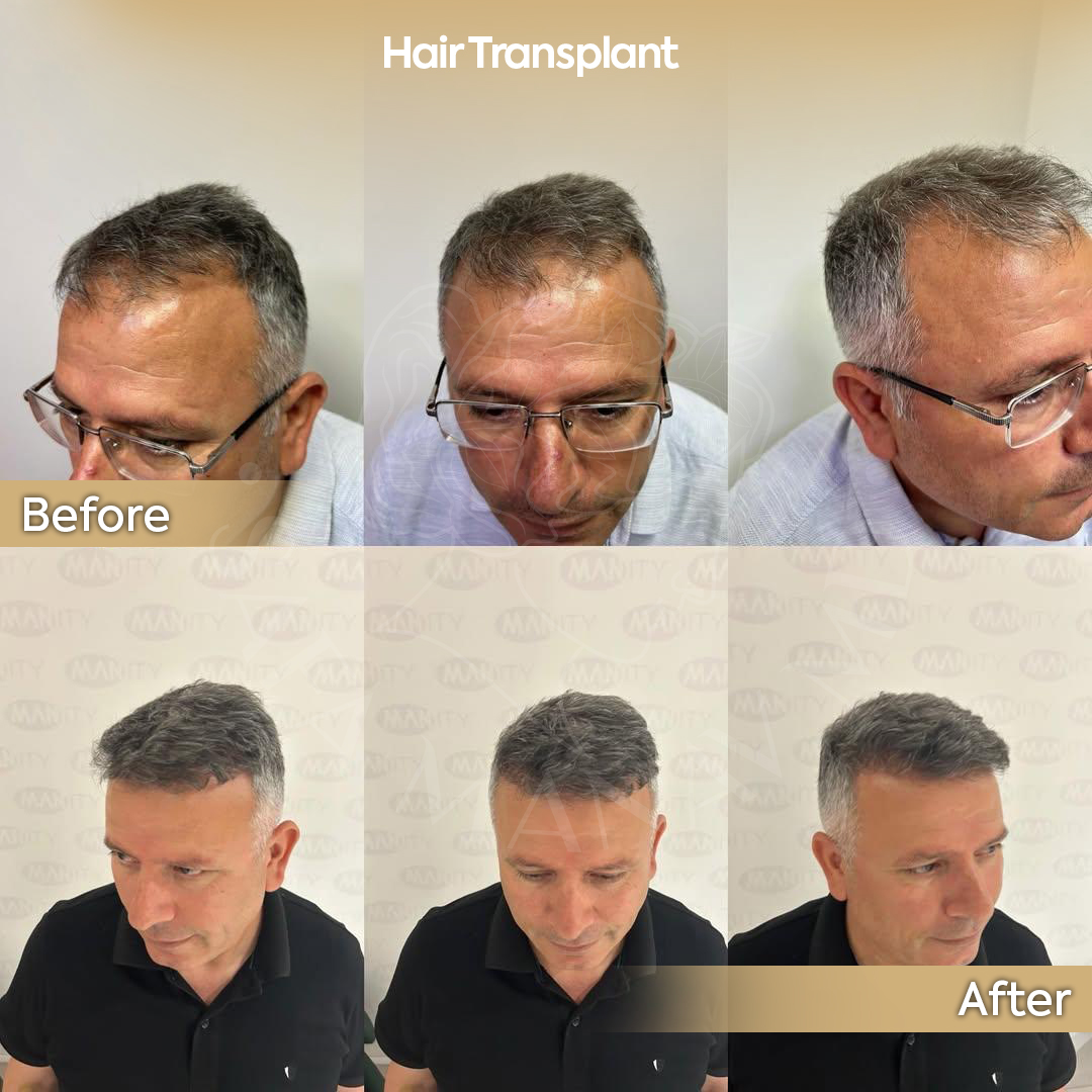 Hair Transplant in Turkey - Plastic Surgery Supervised Hair Transplant ...