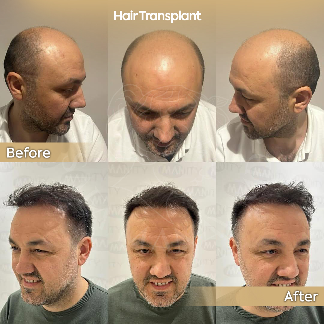 Hair Transplant in Turkey - Plastic Surgery Supervised Hair Transplant ...