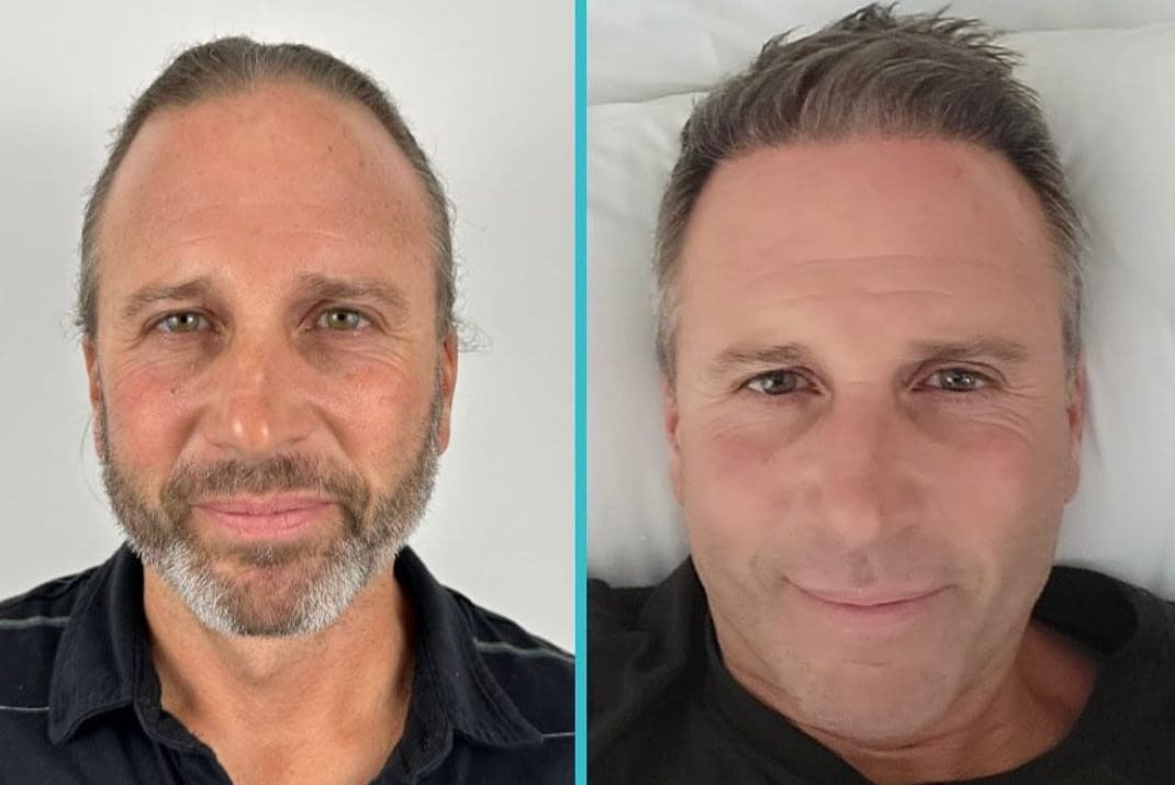 Hair Transplant in Turkey - Plastic Surgery Supervised Hair Transplant ...